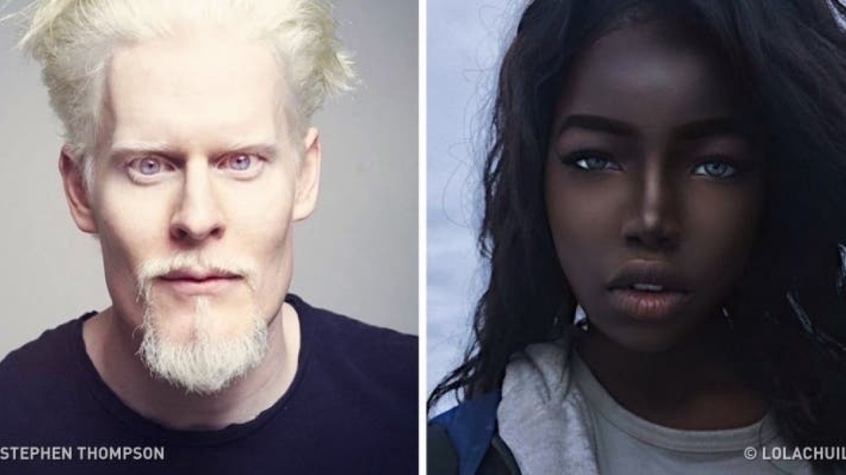 8 charming people with a unique skin color