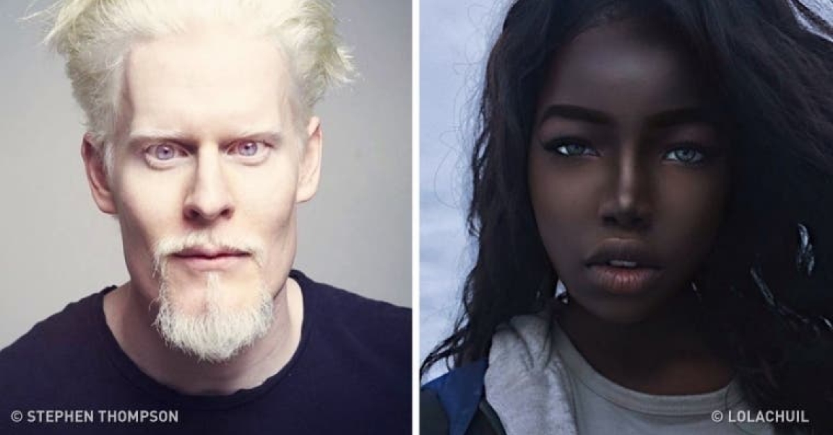 8 charming people with a unique skin color